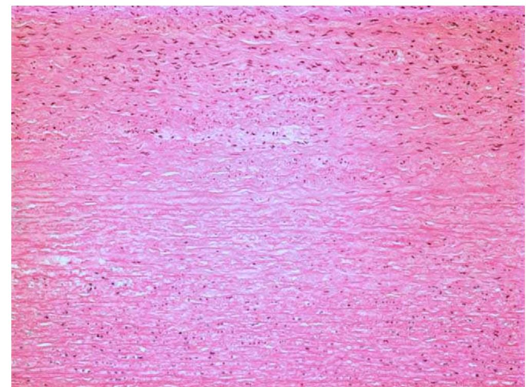 Figure 2 - from Surgical Pathology of the Ascending Aorta: A
