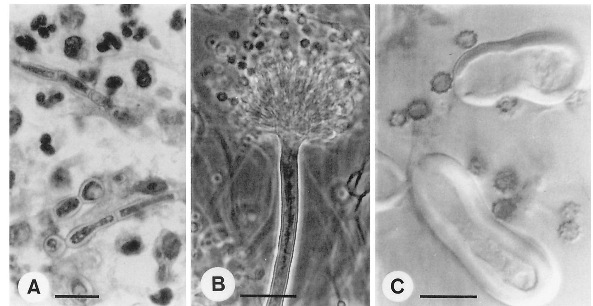 (a) giemsa stain of biopsy tissue from the left forearm