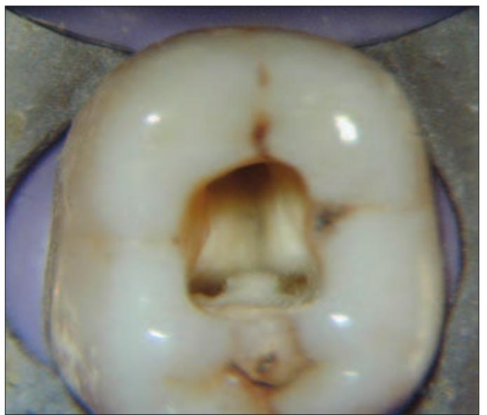 Figure 3 - from A practical guide to endodontic access