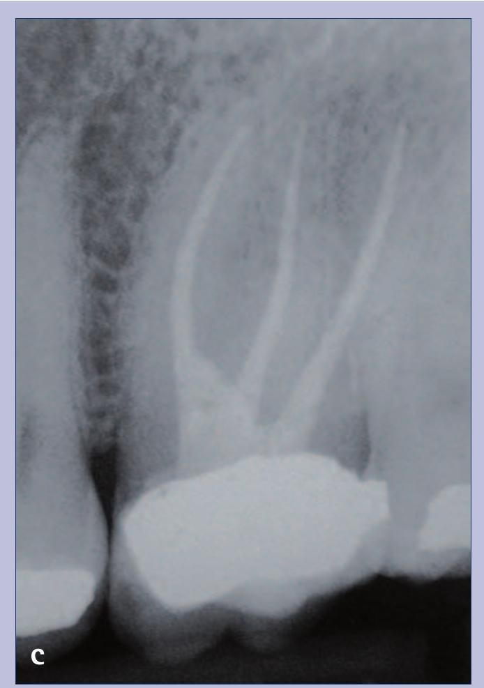(PDF) A practical guide to endodontic access cavity preparation in ...