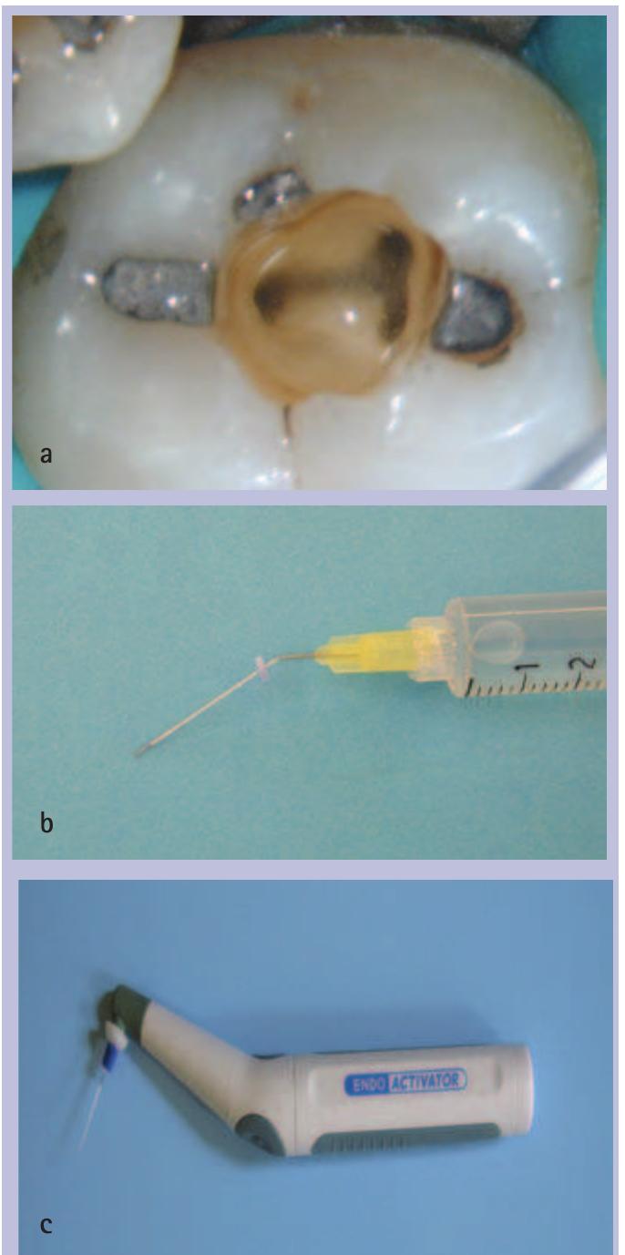 (a) the root canal system and pulp chamber should be