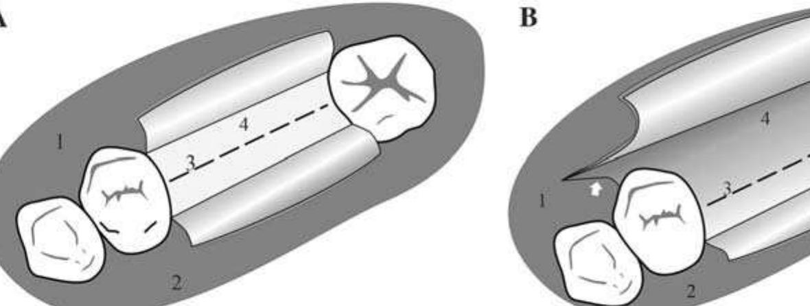 (PDF) Flap and incision design in implant surgery: clinical and ...