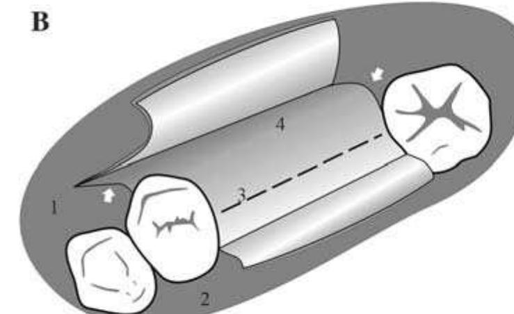 Figure 2 - Flap and incision design in implant surgery:
