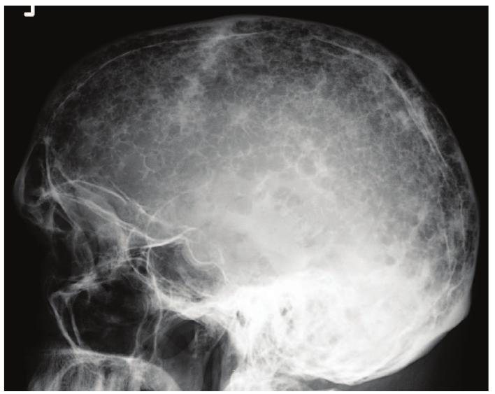 Lateral radiograph skull: diffuse lytic lesions giving