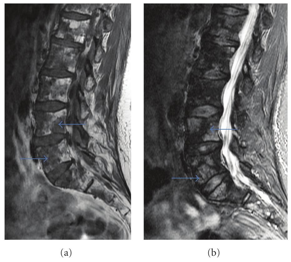 Ficure 7: (a) mri sagittal t1-weighted sequence lumbar