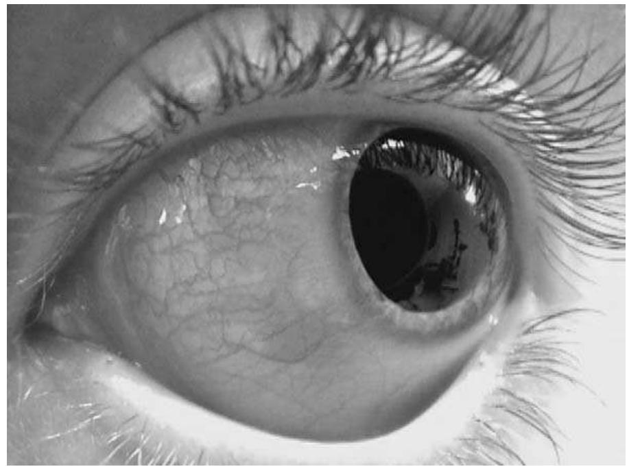Episcleritis. note sector of conjunctival injection with