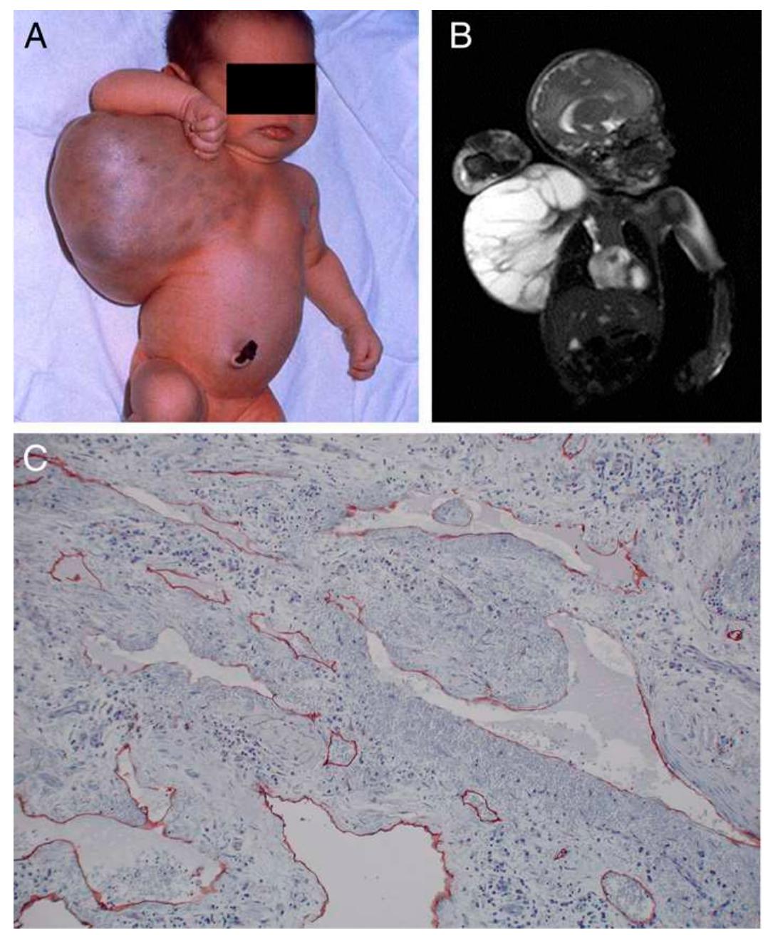 Lymphatic malformation. a, large macrocytic lm of the