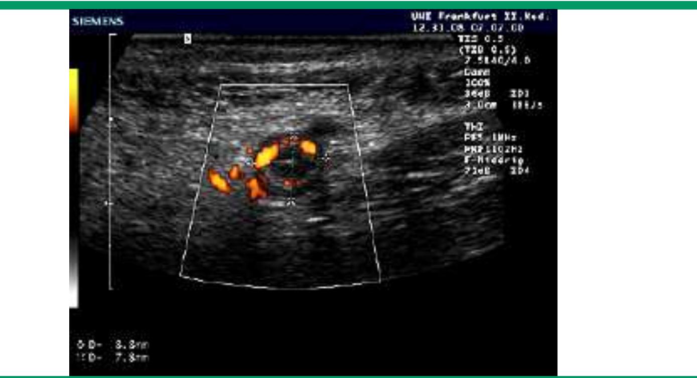 Figure 6 - Acute appendicitis in adults Diagnostic