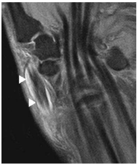 De quervain’s tenosynovitis. coronal fat-suppressed