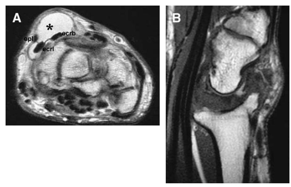 Tenosynovitis of the extensor pollicis longus, extensor