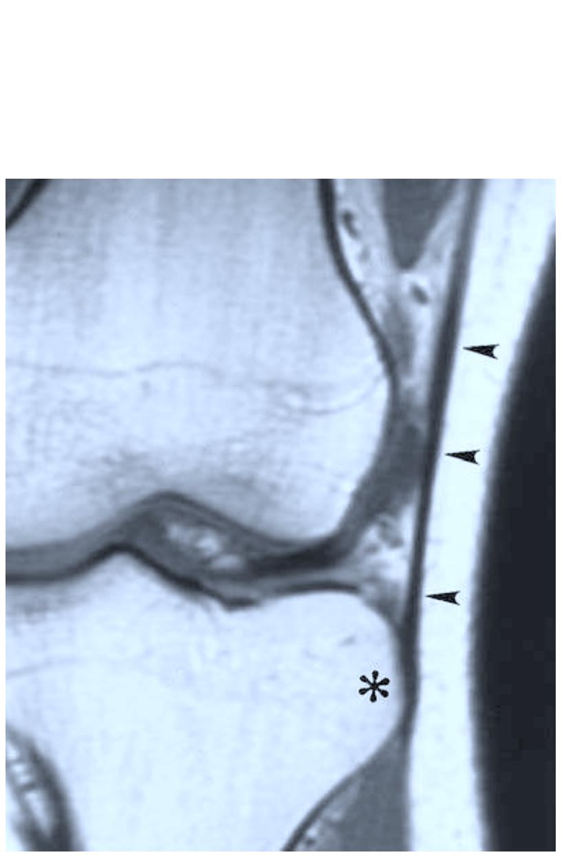Normal iliotibial tract. coronal t1- weighted mr image