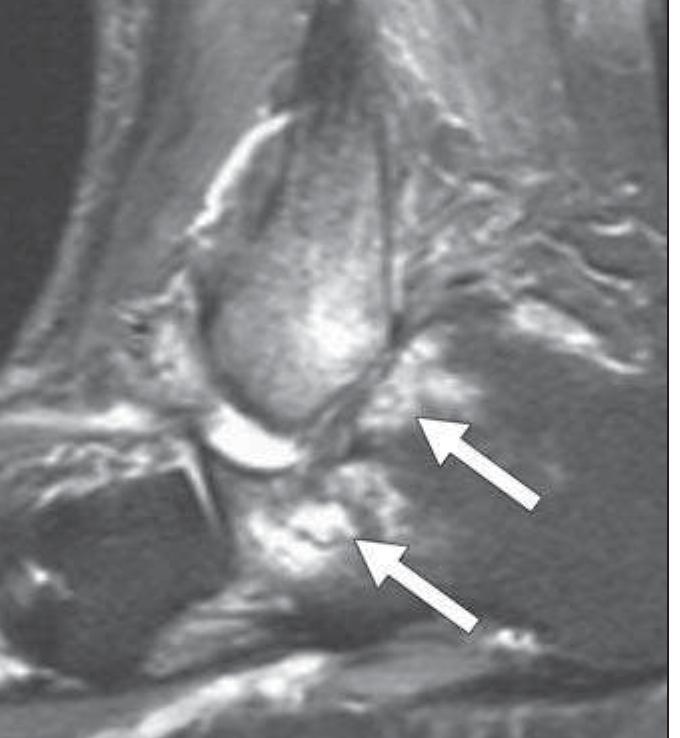 —hindfoot valgus and calcaneofibular impingement in