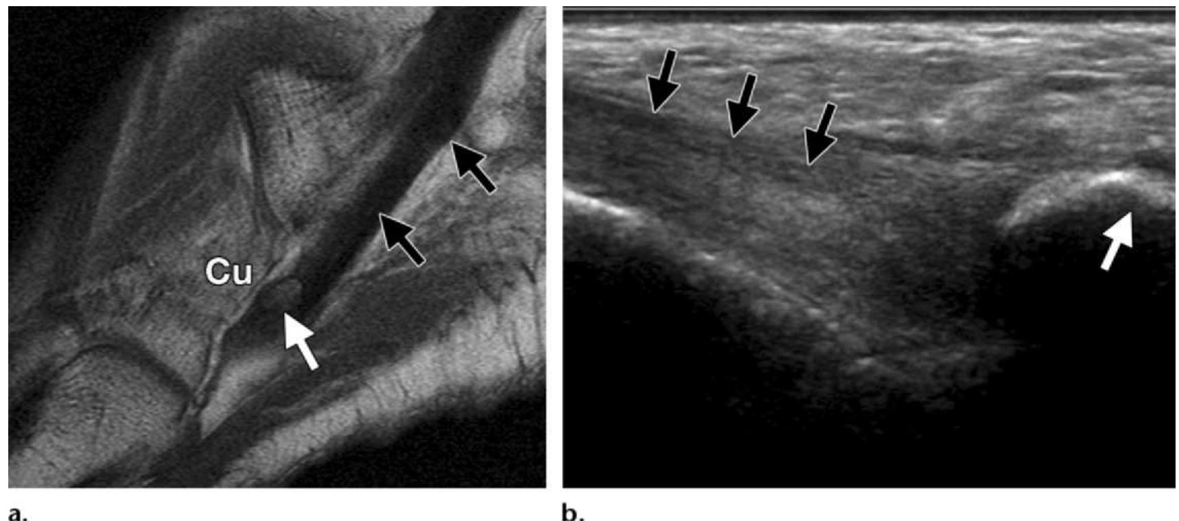 Os peroneum. (a) sagittal t1-weighted mr image shows an oval