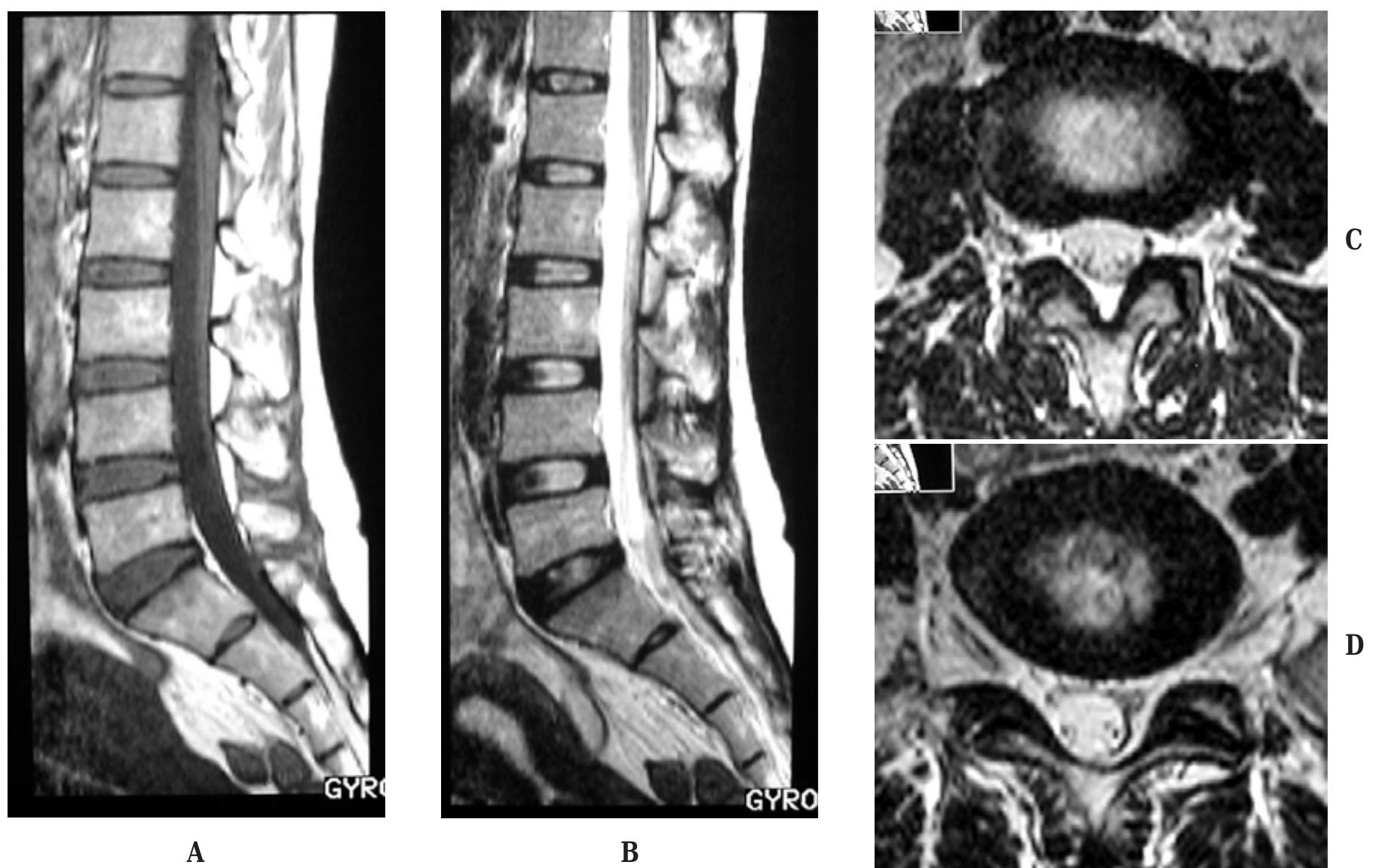 Mri lumbar spine in full protocol (a) sagittal t1wi,