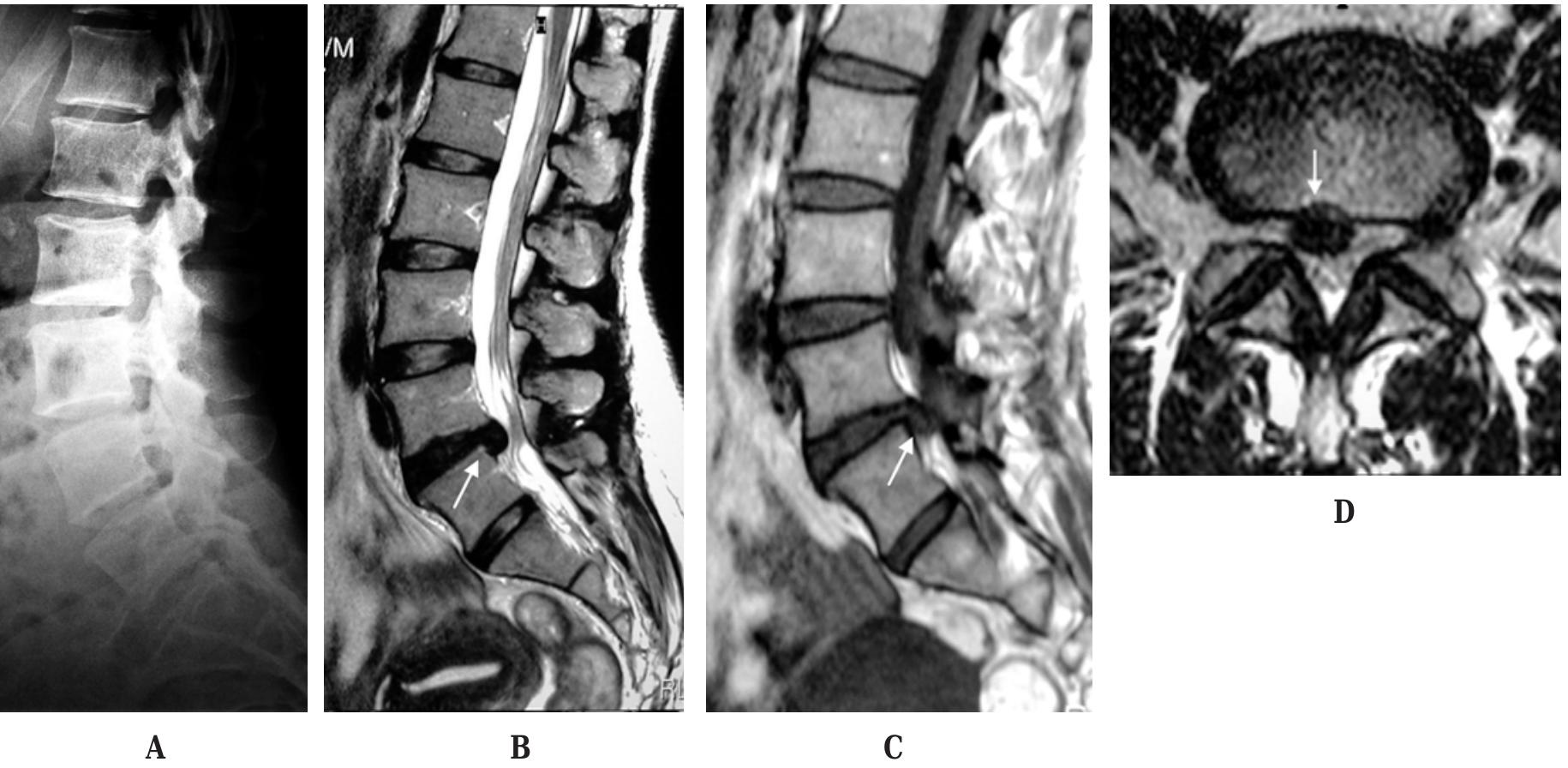 Lumbar disc herniation. (a) the lateral roengenogram of