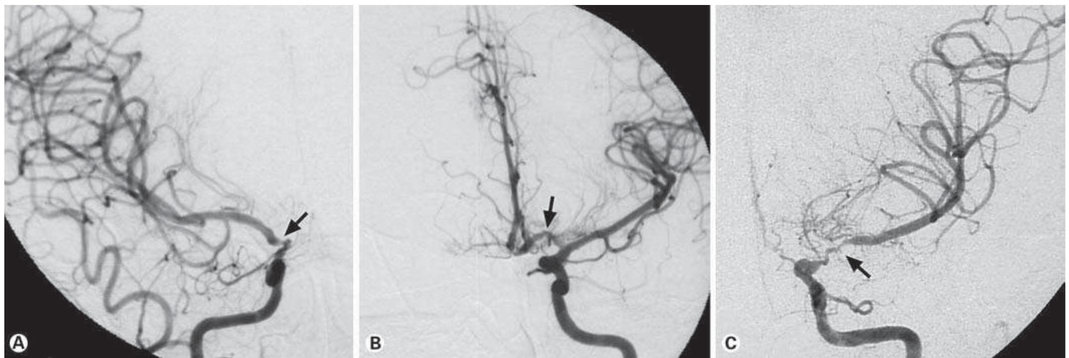 A initial anteroposterior digital subtraction angiography