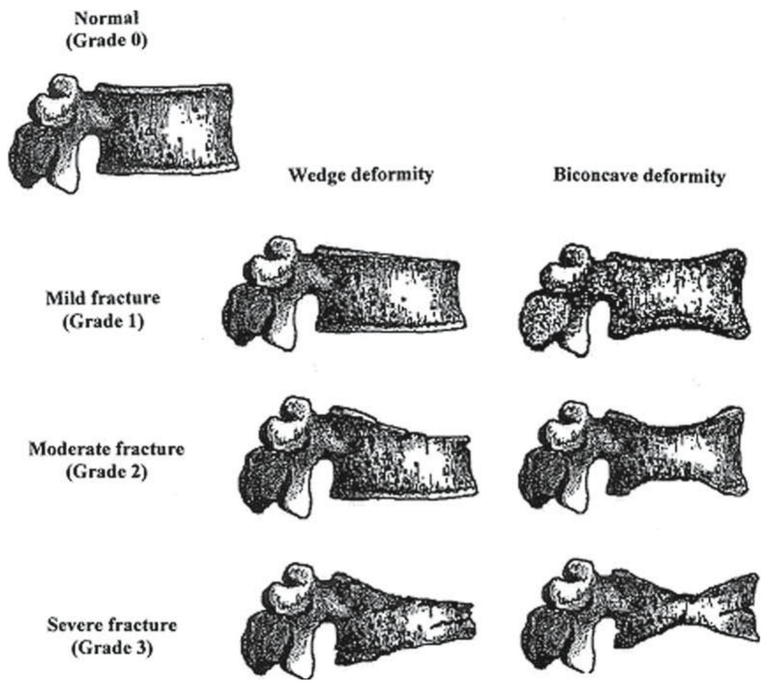 A vertebral deformity does not always represent a ver-