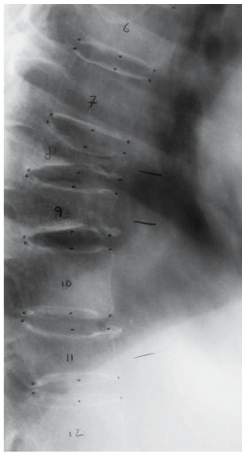 Lateral thoracic radiograph shows a grade 3 fracture t8 and