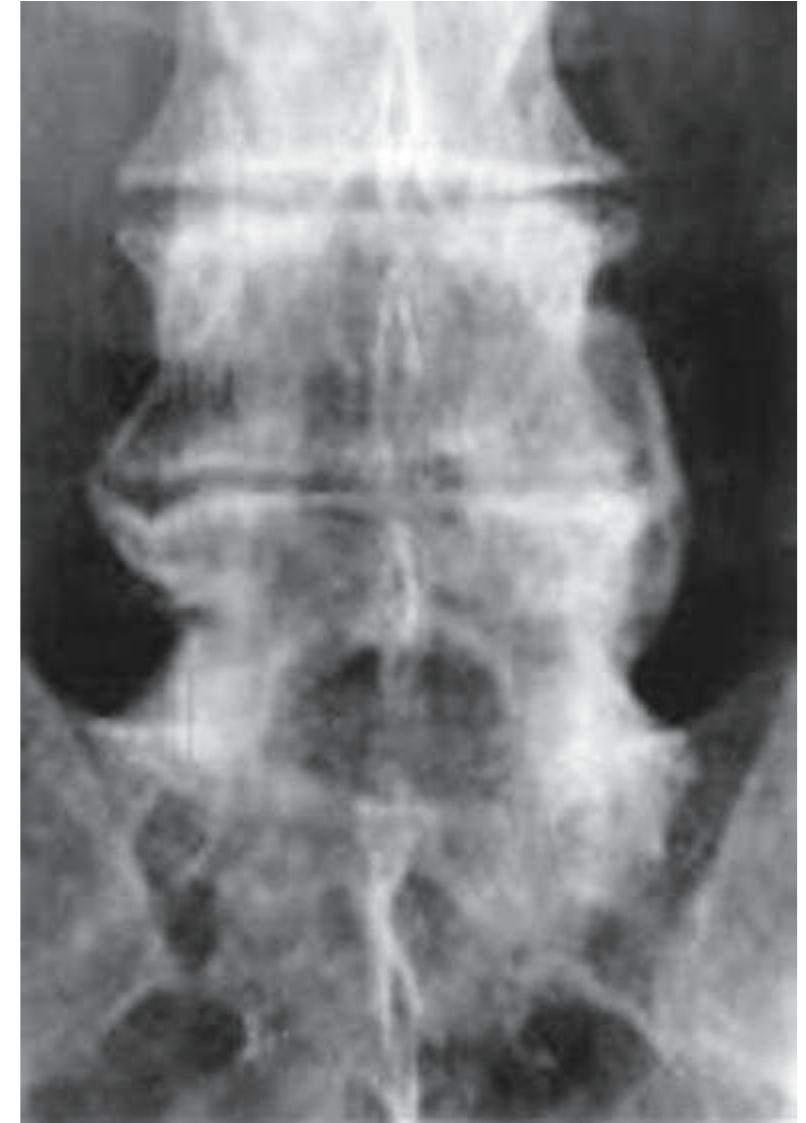 Anteroposterior radiograph of the lumbar spine showing a