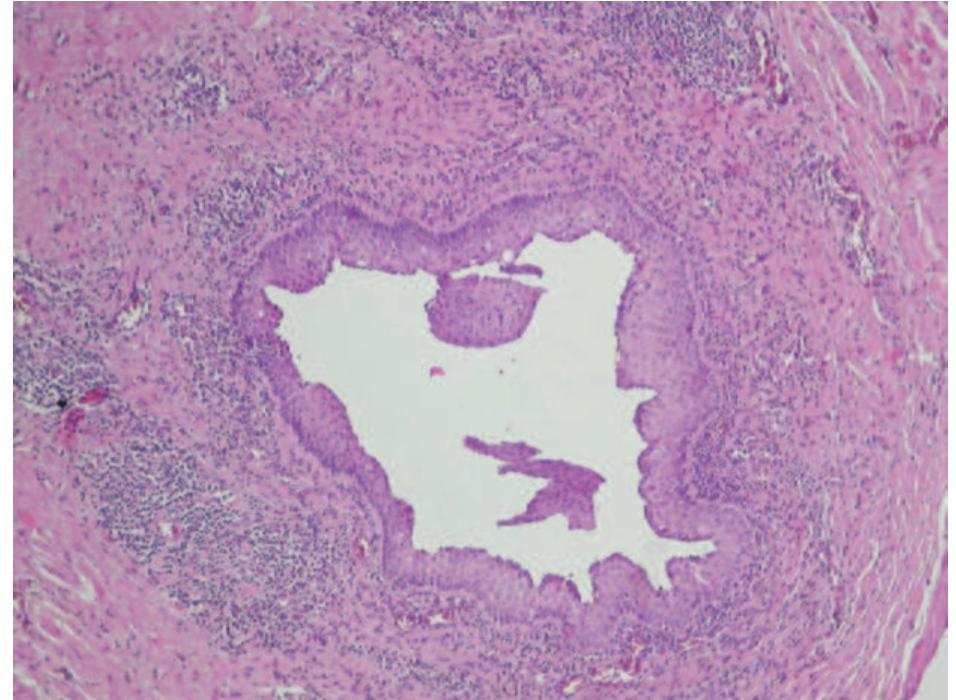 Cystic walls lined with stratified squamous epi- thelium