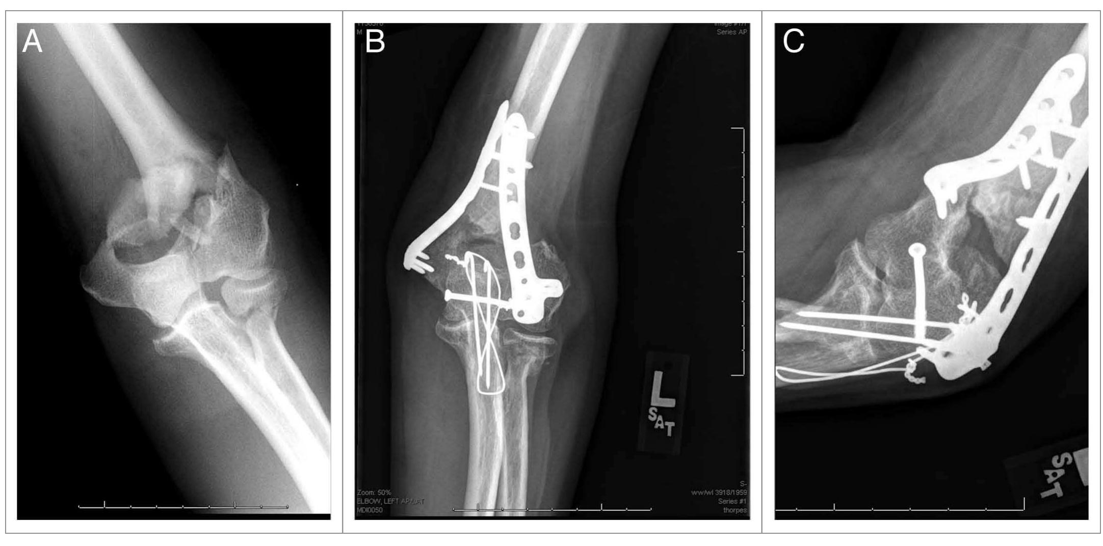 (PDF) Bone grafts, bone substitutes and orthobiologics: The bridge ...