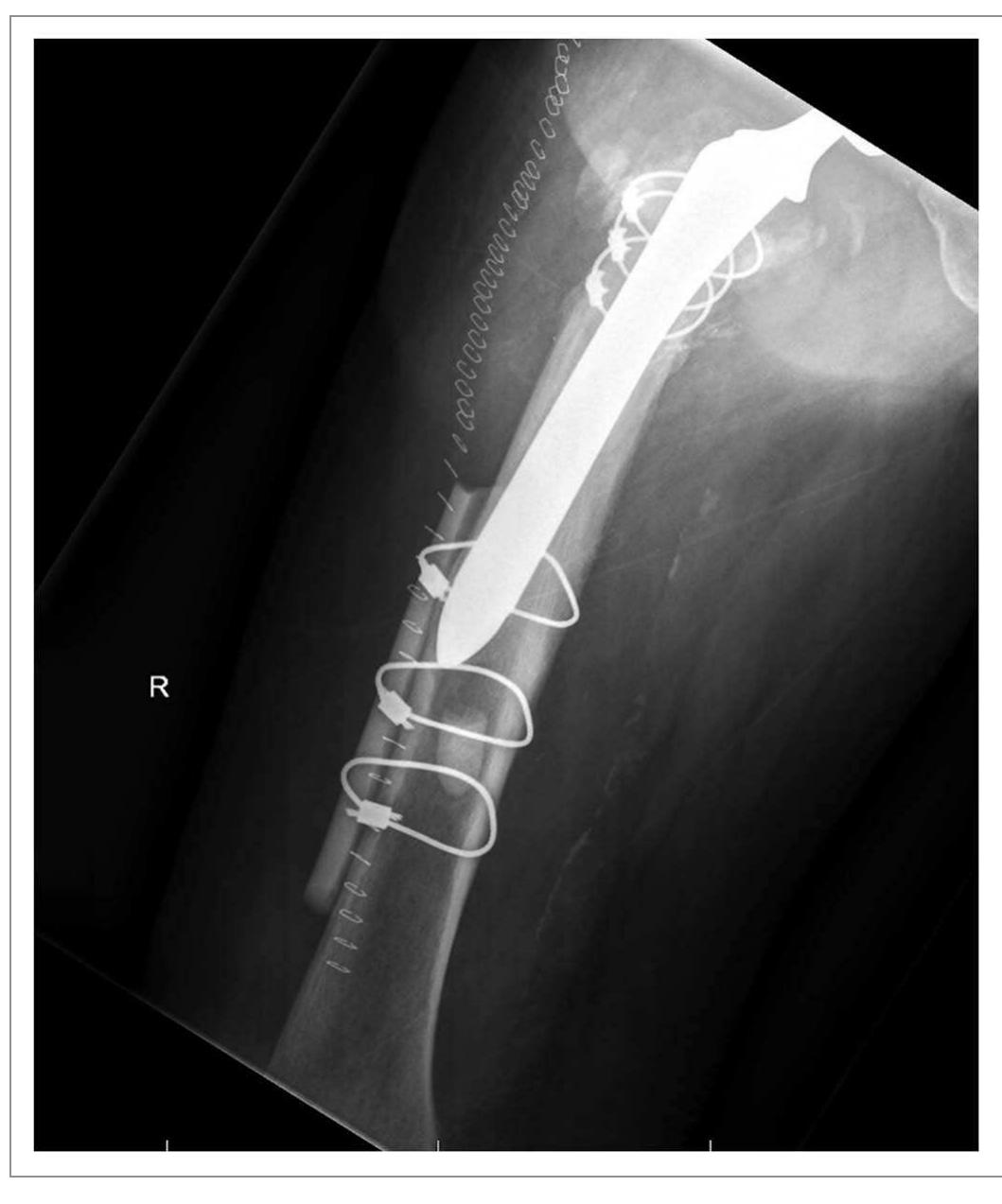 Ap radiograph of a periprosthetic femur fracture following