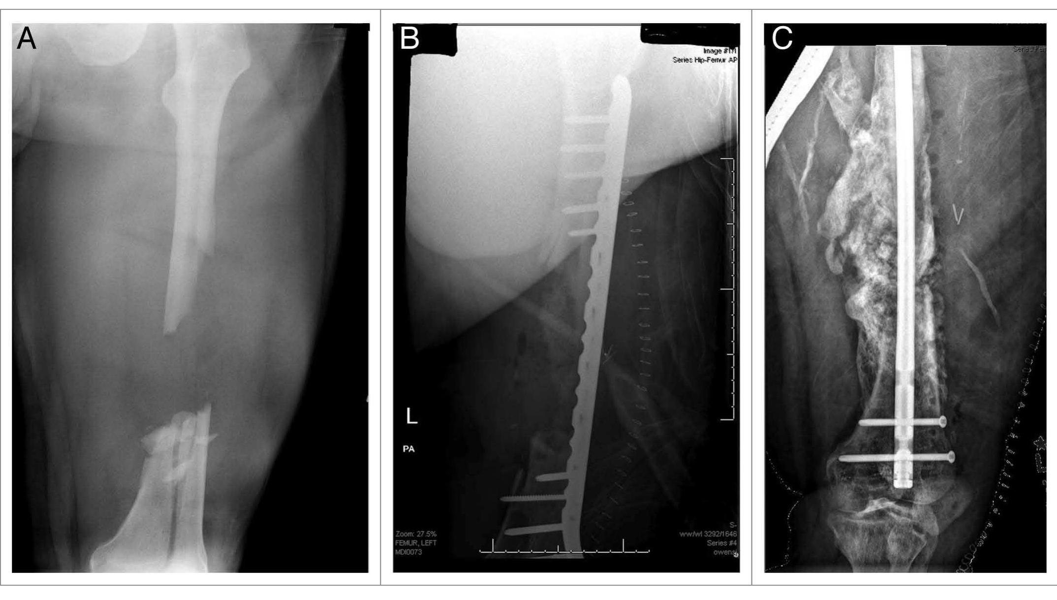 (a) ap radiograph of a large, segmental femur fracture with