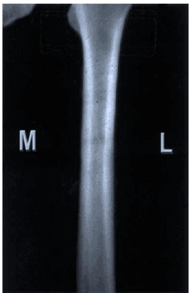 Radiograph of a normal femoral shaft. note the quality and
