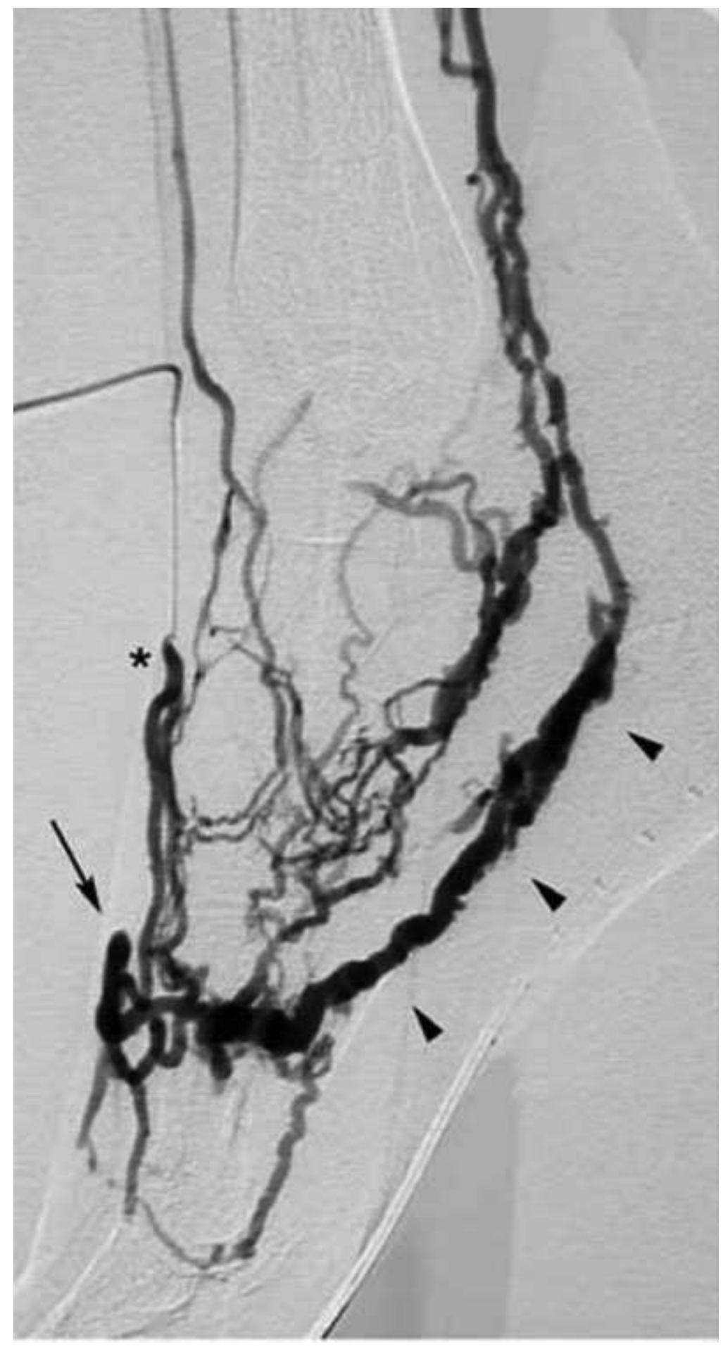 Phlebogram showing the deep plantar venous system with a