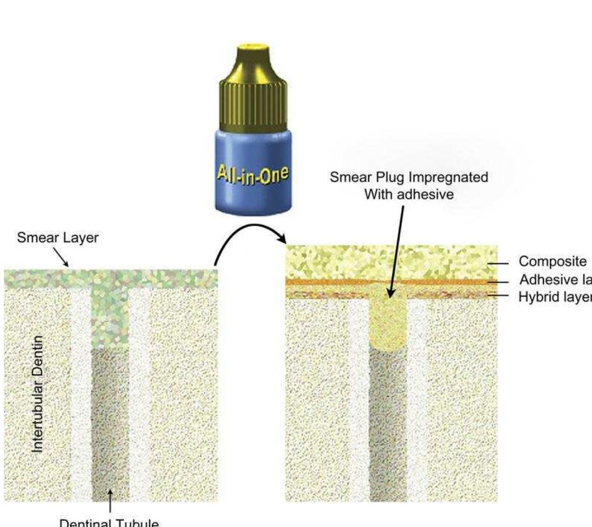 Figure 5 - Options for Dentin Bonding - Total Etch Or Self