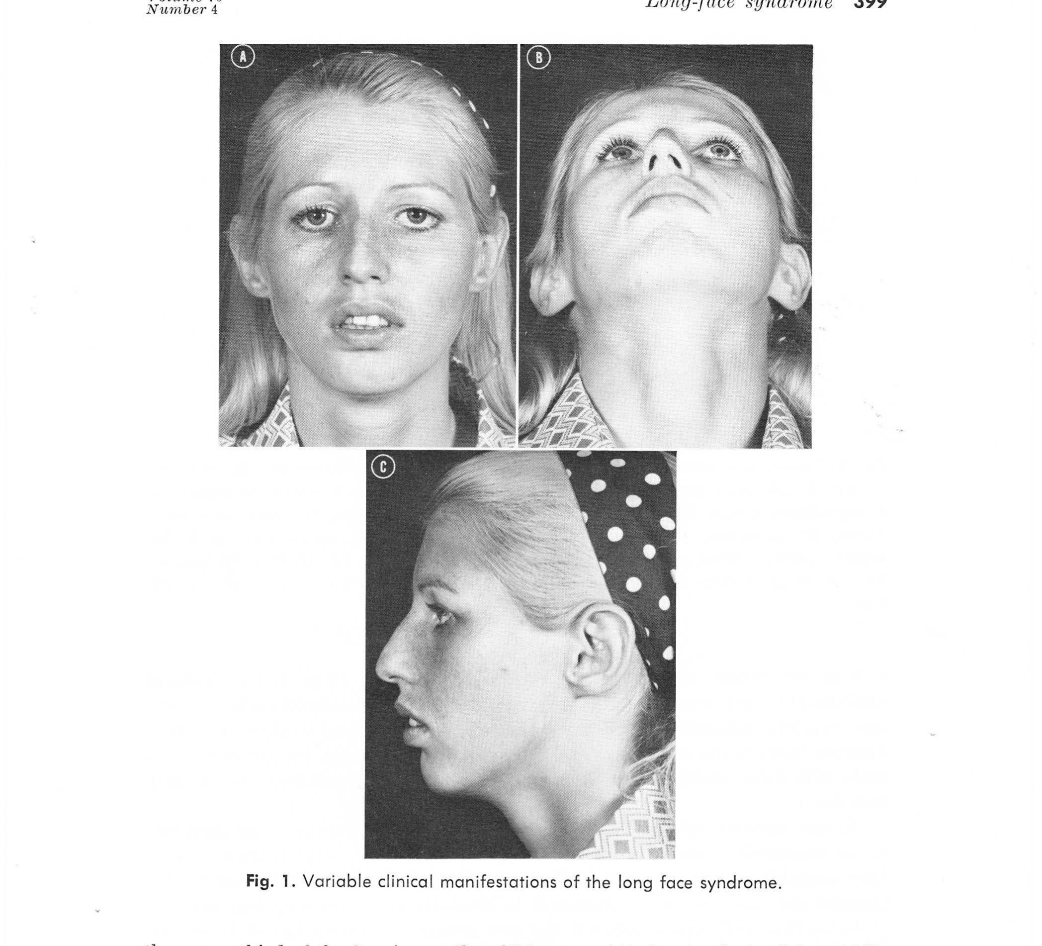 Figure 2 - The long face syndrome: vertical maxillary excess