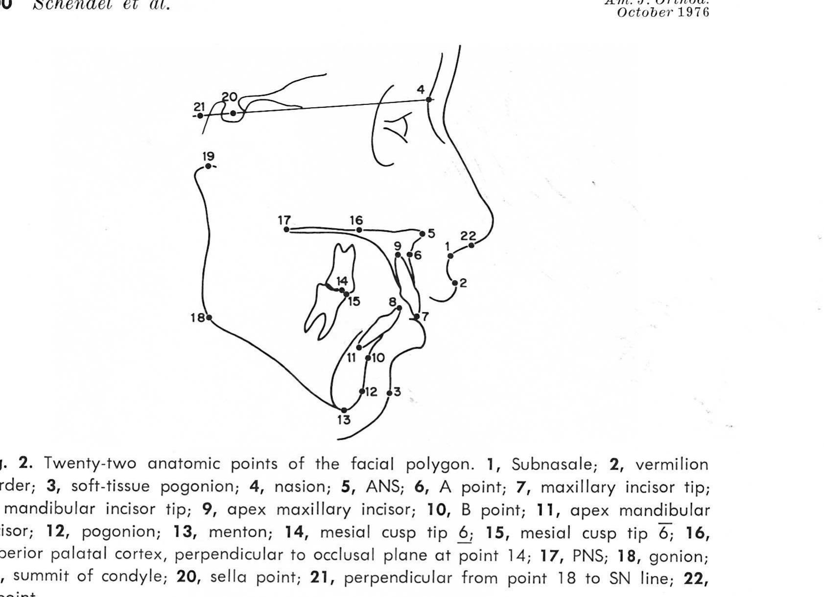 Figure 3 - The long face syndrome: vertical maxillary excess