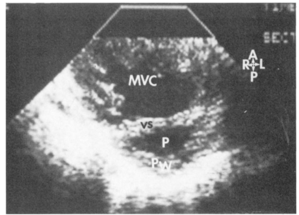 Parasternal short-axis view showing a posterior pouch (p) in