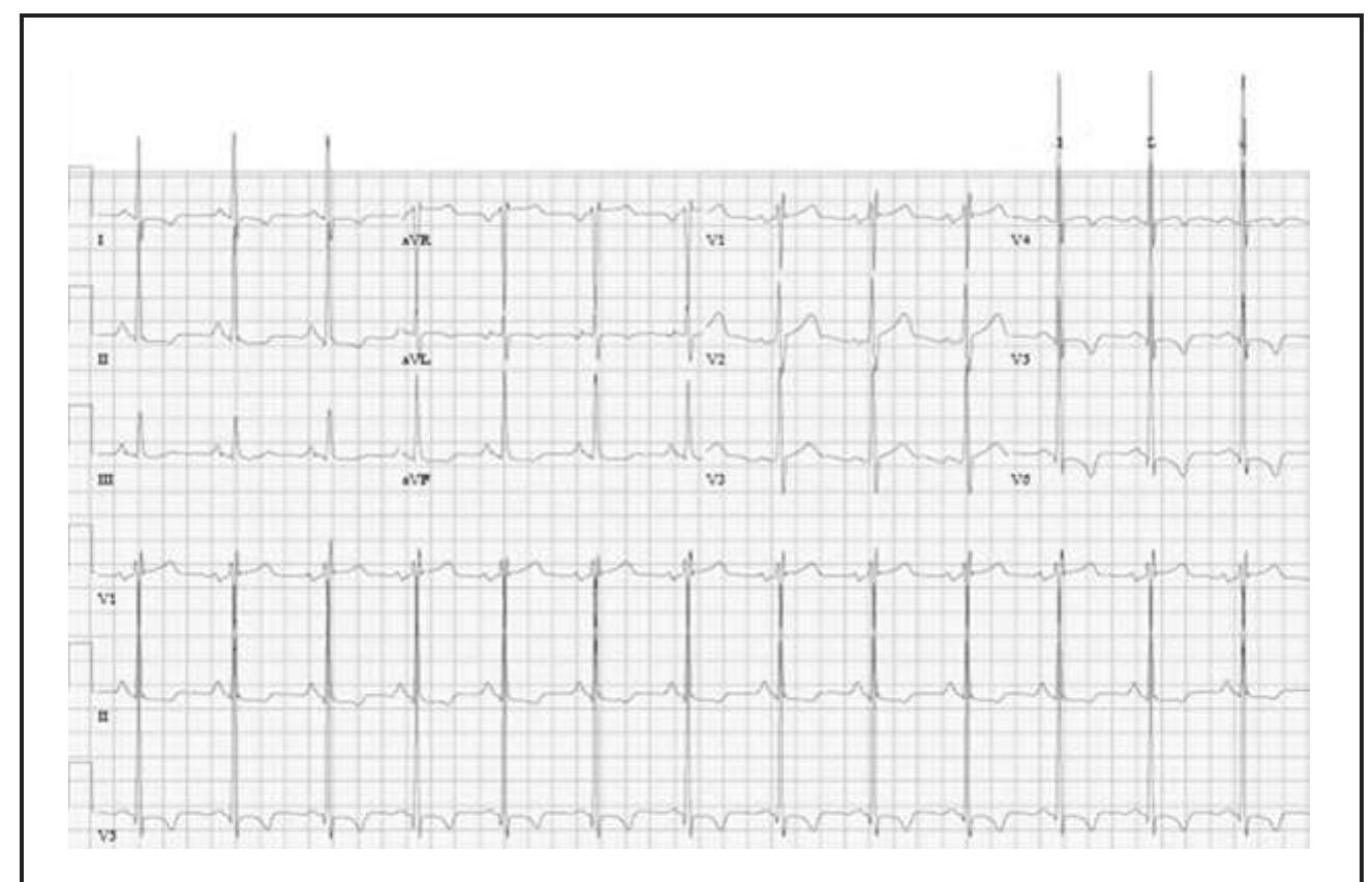 Electrocardiogram of a patient with severe aortic stenosis