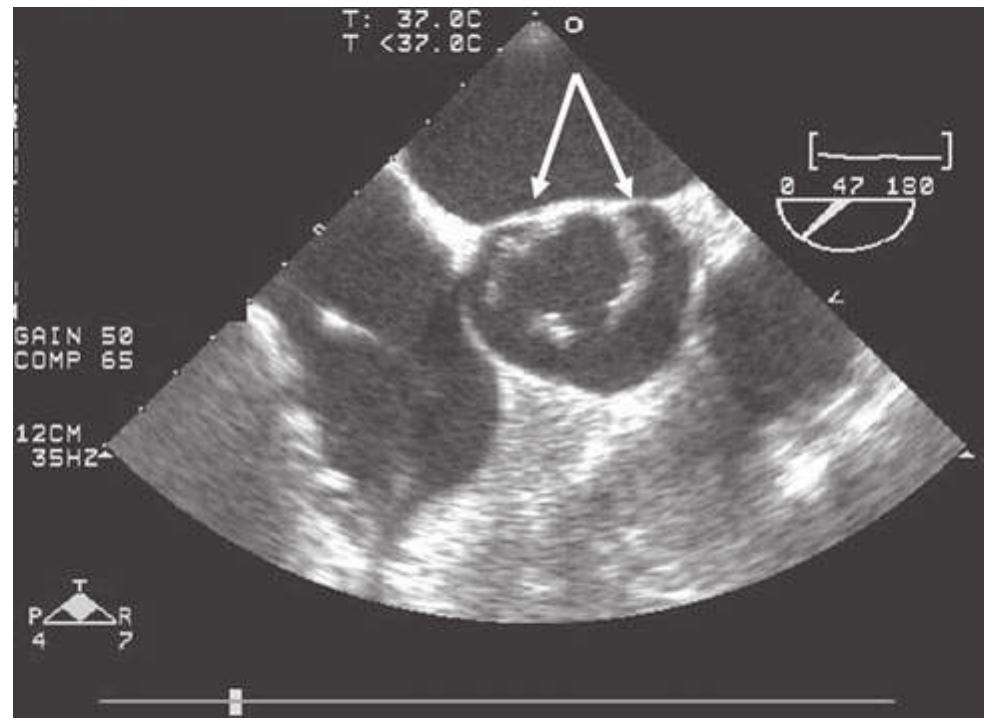 Transesophageal echocardiographic short-axis view of a