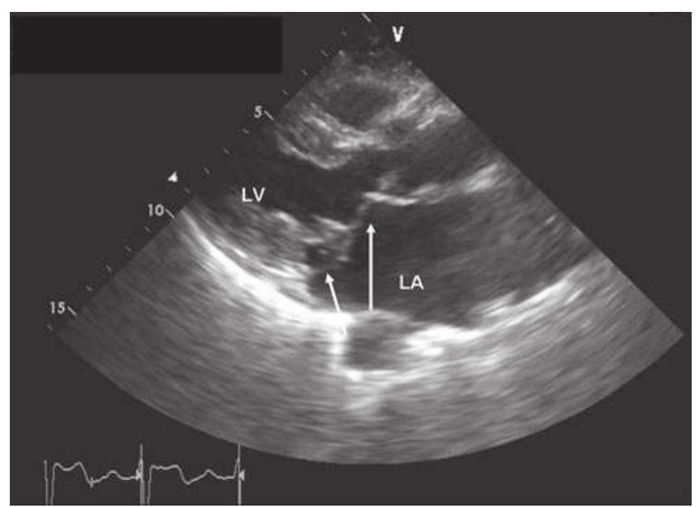Parasternal long-axis echocardiographic view of a pa- tient