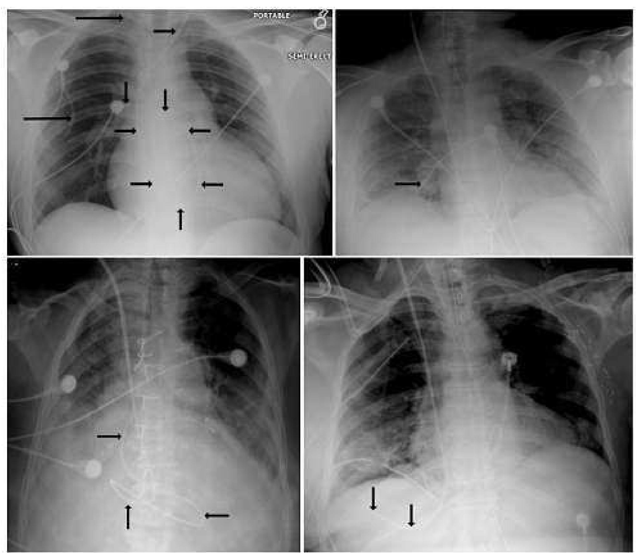 (a, top left): normal positioning of the pulmonary artery