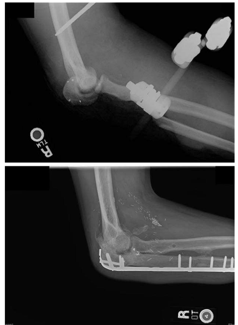 Figure 5 - Revisiting the Scapular Flap