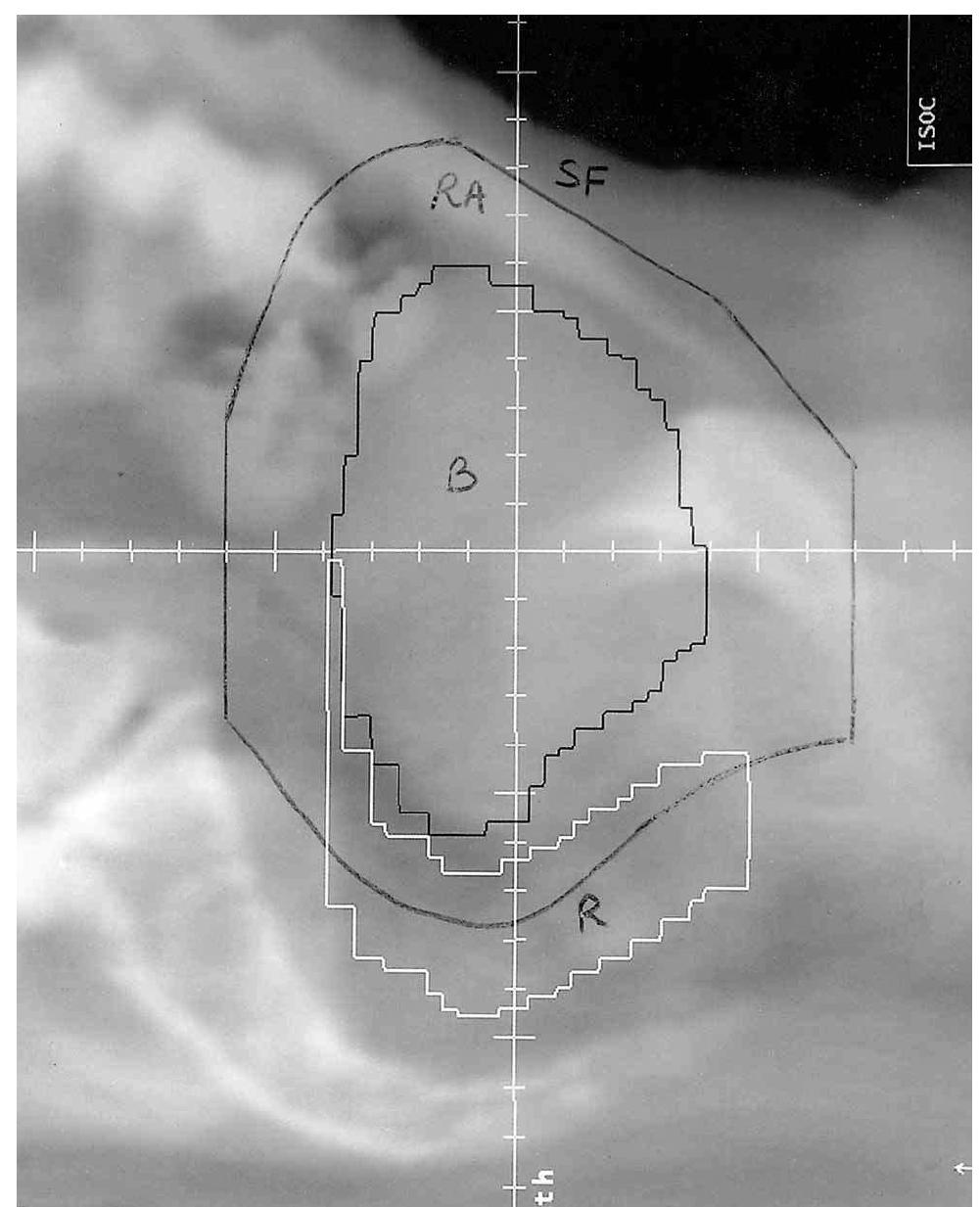 Lateral digitally reconstructed radiograph for treatment of