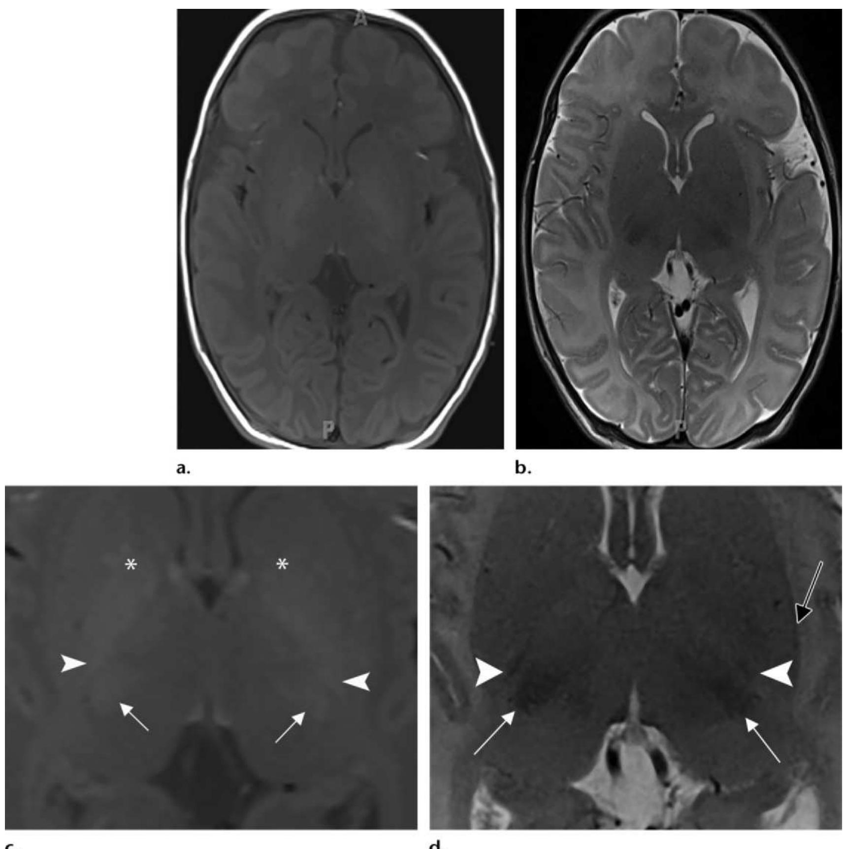 Normal mr imaging appearance of the term neonatal brain in a