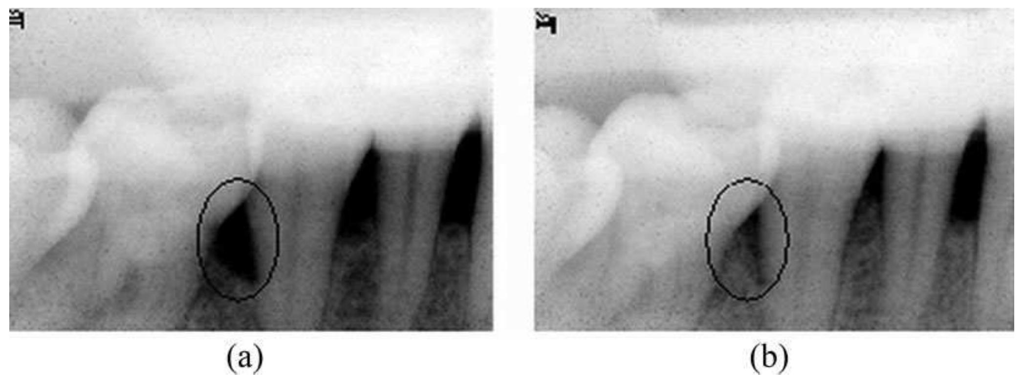 (a) preoperative bone defect. (b) bone fill after 6 months