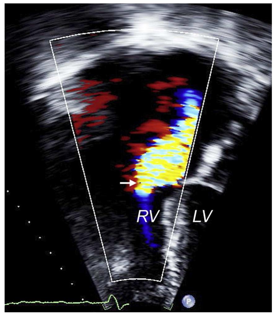 Moderate tr (arrow) due to impingement of the vsd patch on