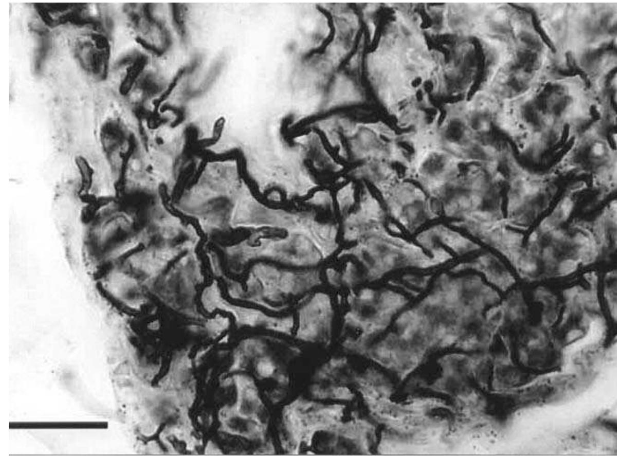Numerous dark staining septate branching fungal hyphae are