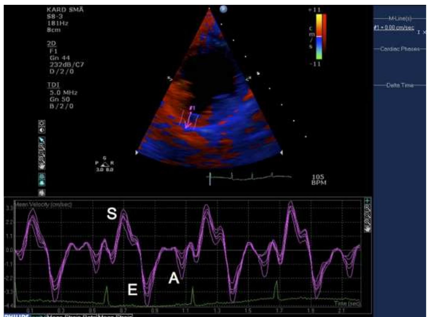 Radial tissue doppler velocity curves of 4 myocardial