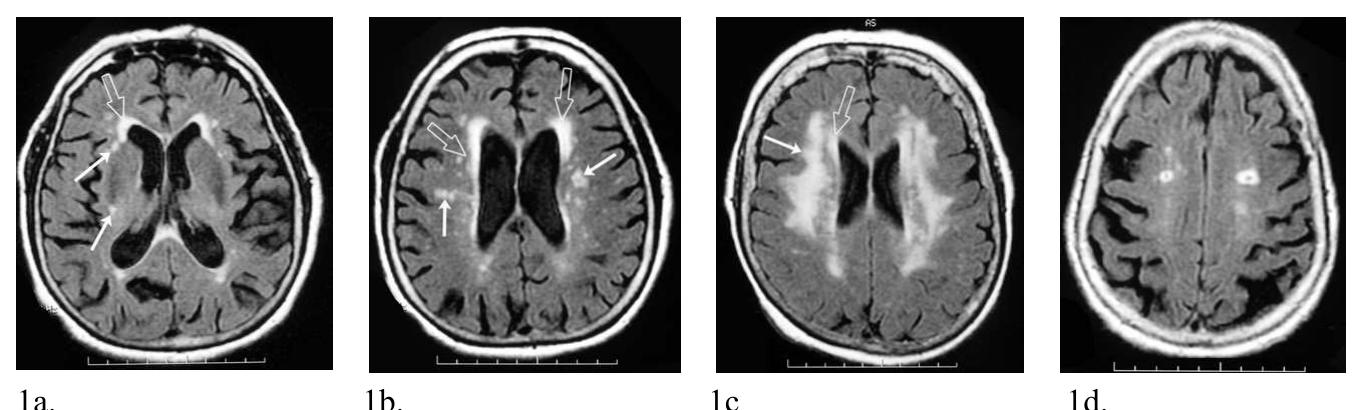 Examples of periventricular hyperintensities (open arrows),