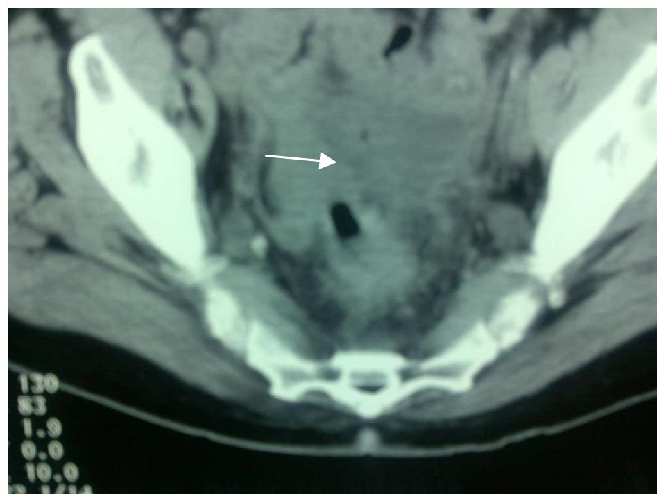 Abdominal ct scan showing colorectal tumour mass