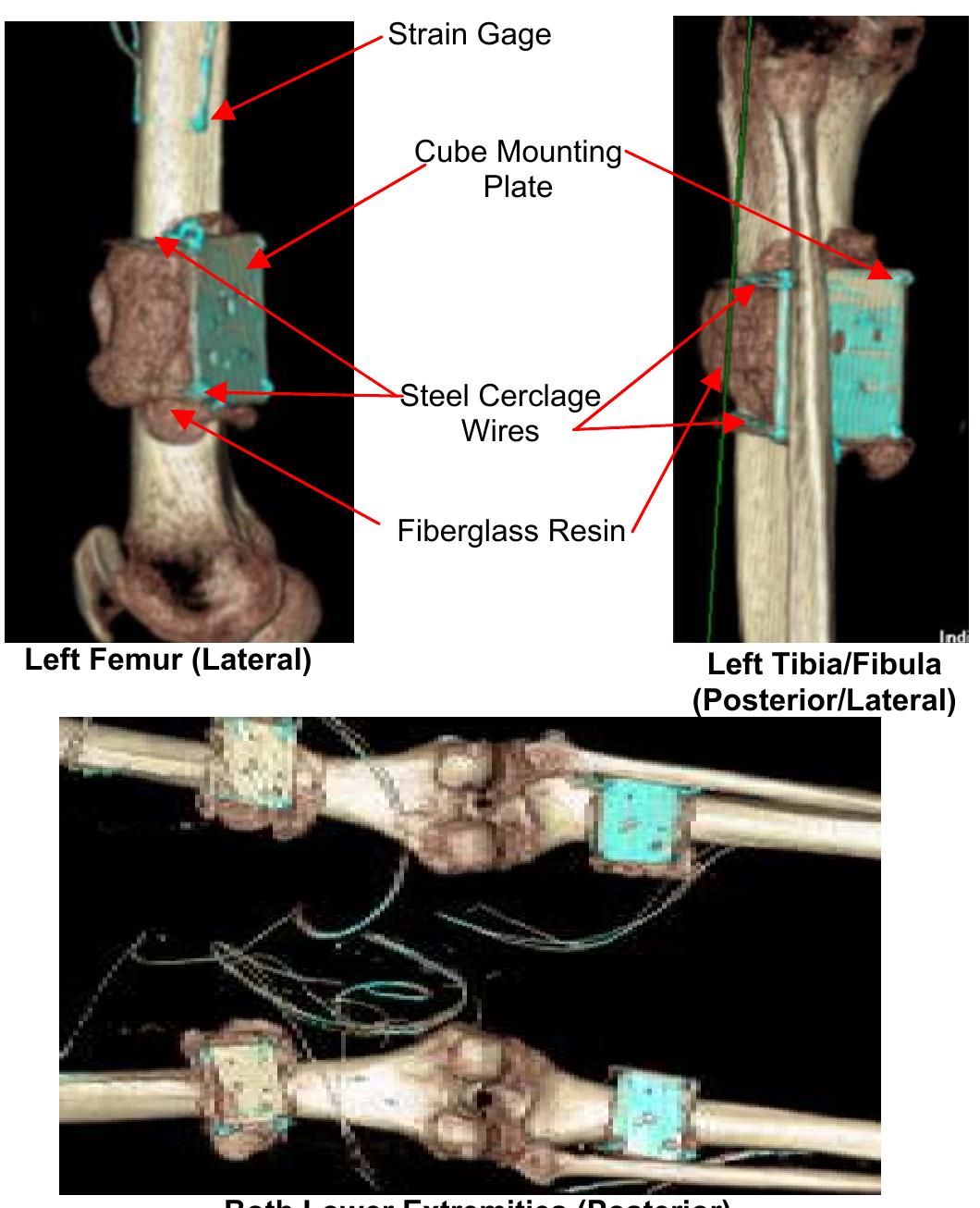 And anterior aspects, and in the left femur and left tibia