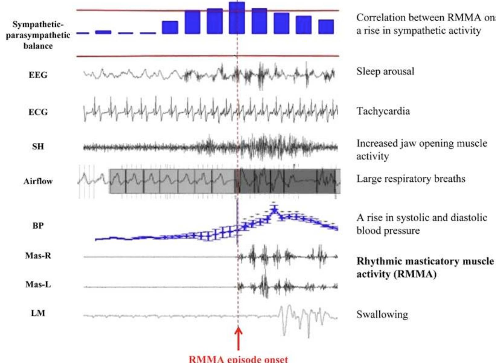 Figure 3 - from Sleep bruxism