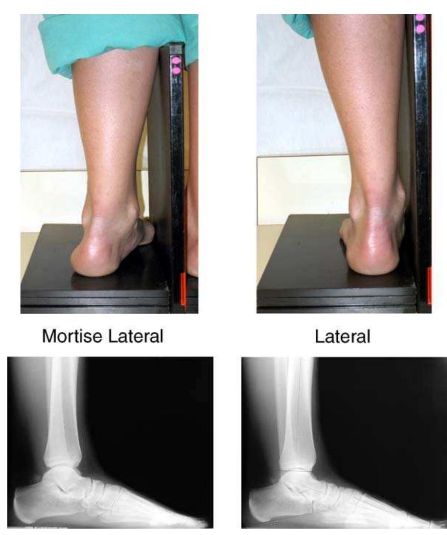 Lateral view radiographs are obtained with the foot placed