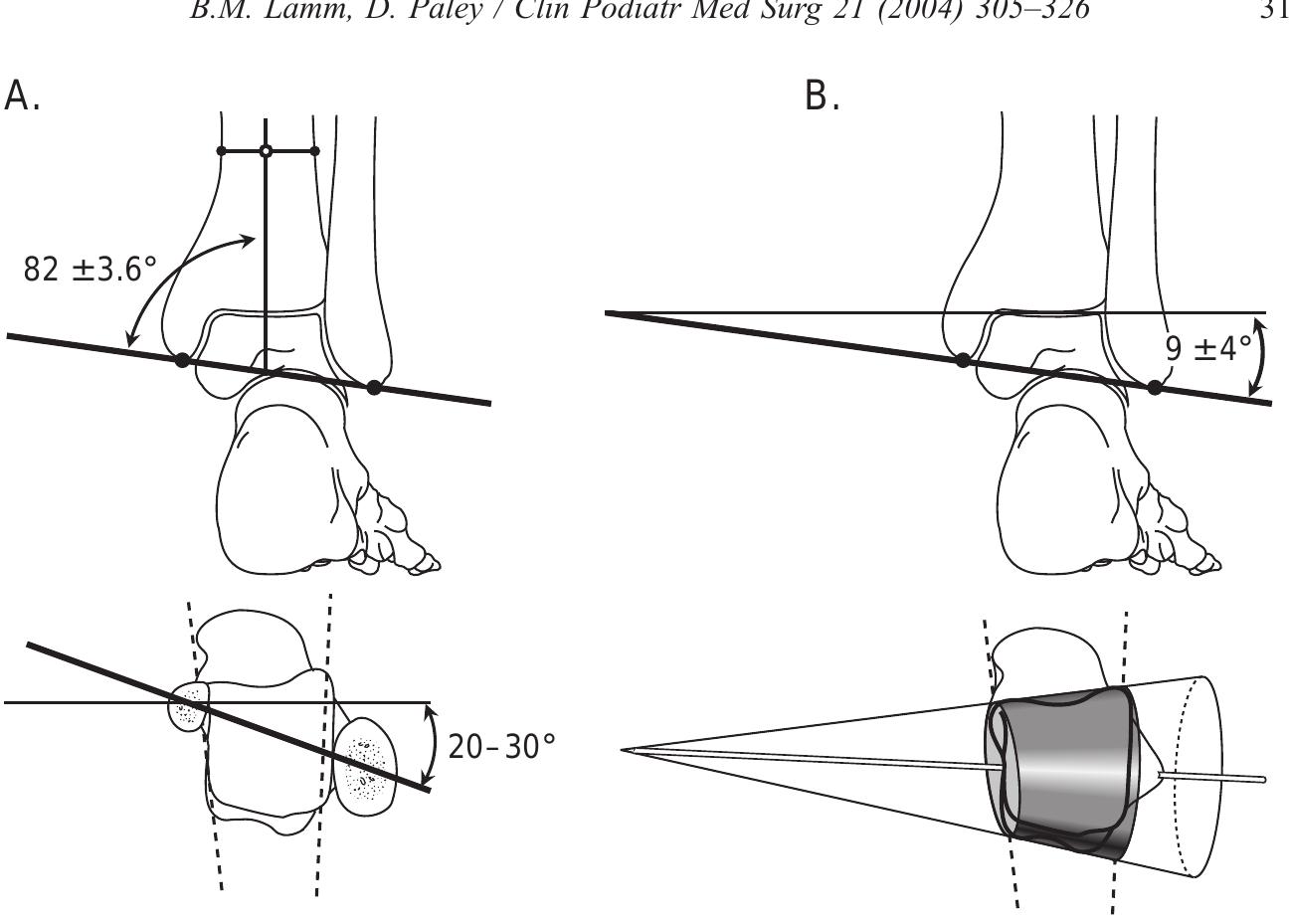 Figure 4 - from Deformity correction planning for hindfoot,